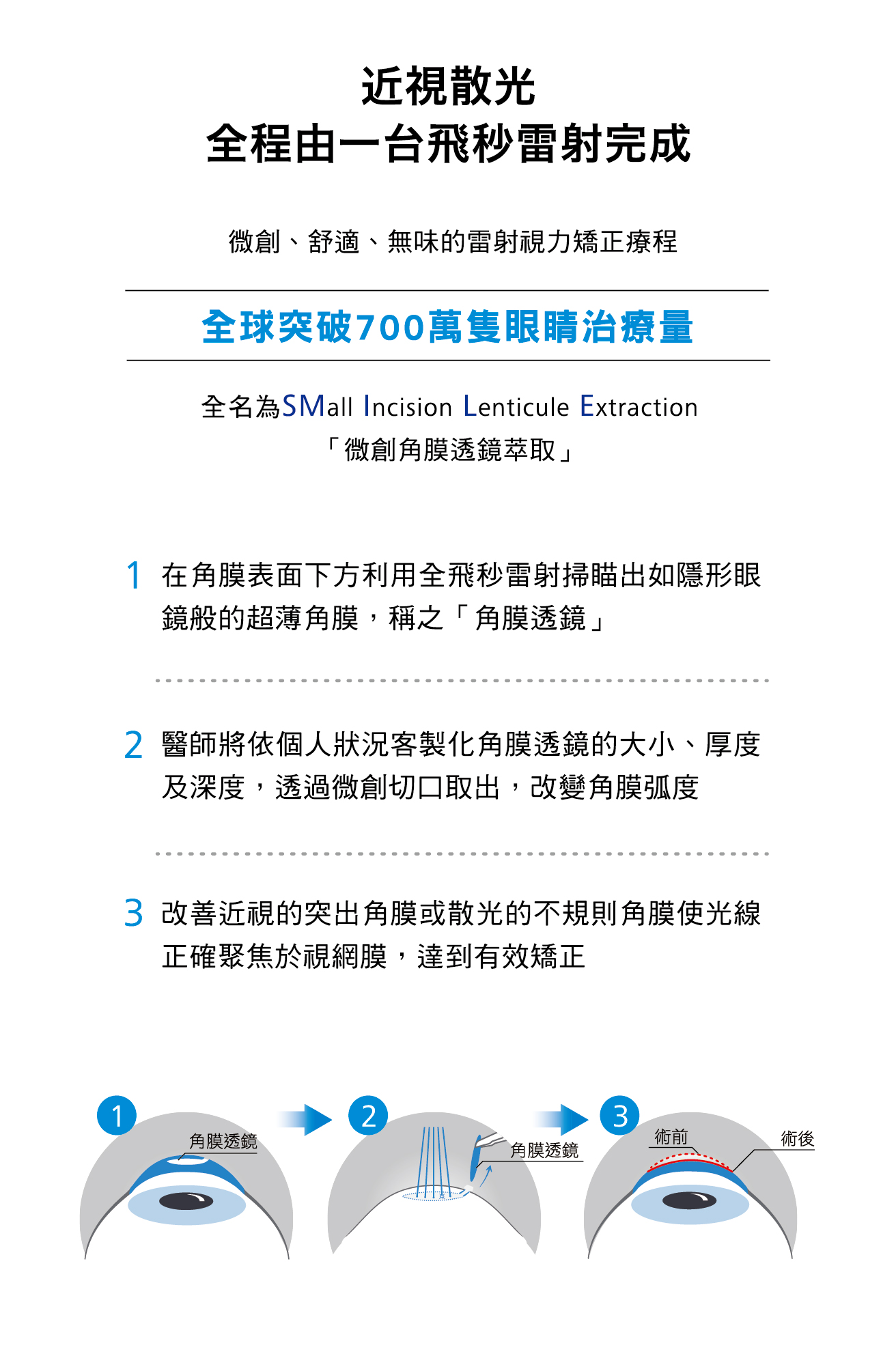 SMILE Pro 新一代德國微創近視雷射｜澄清眼科 | 服務項目